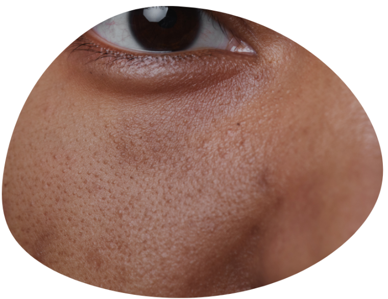 Textured Skin Treatment | DermDox Skin Solutions